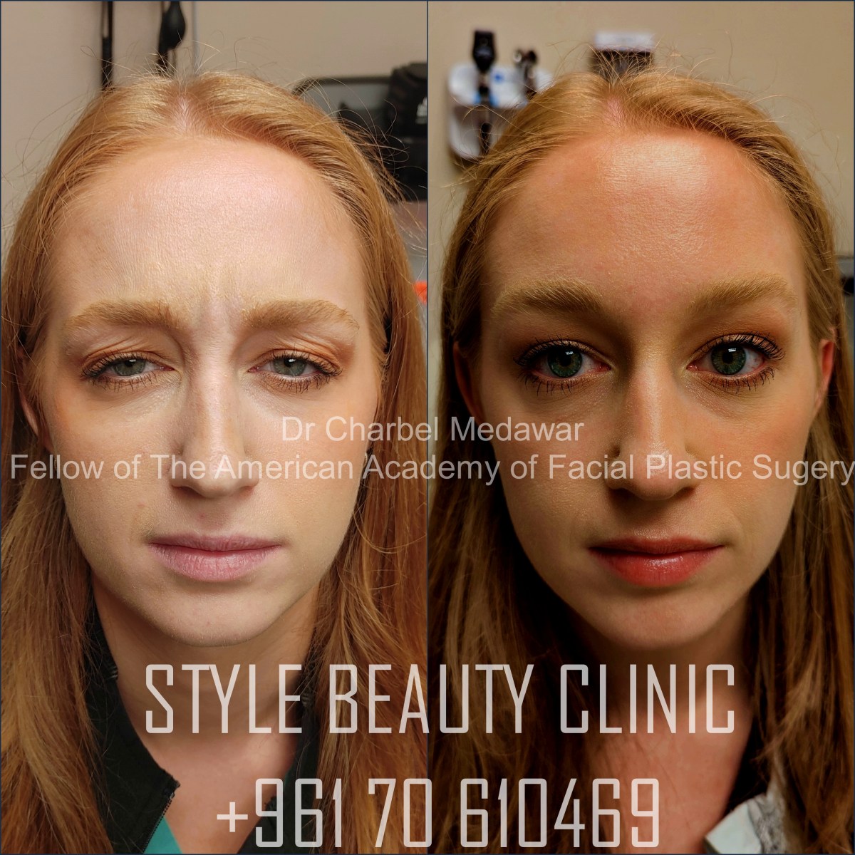 Dr Charbel Medawar: Botox Uses – Dr Charbel Medawar Plastic Surgery Lebanon