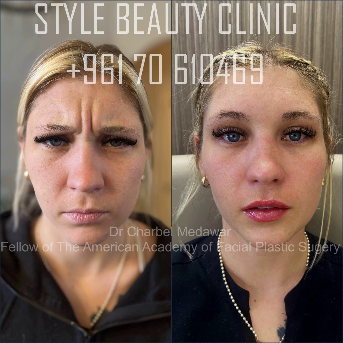 Best Botox Doctor In Lebanon – Dr Charbel Medawar Plastic Surgery Lebanon