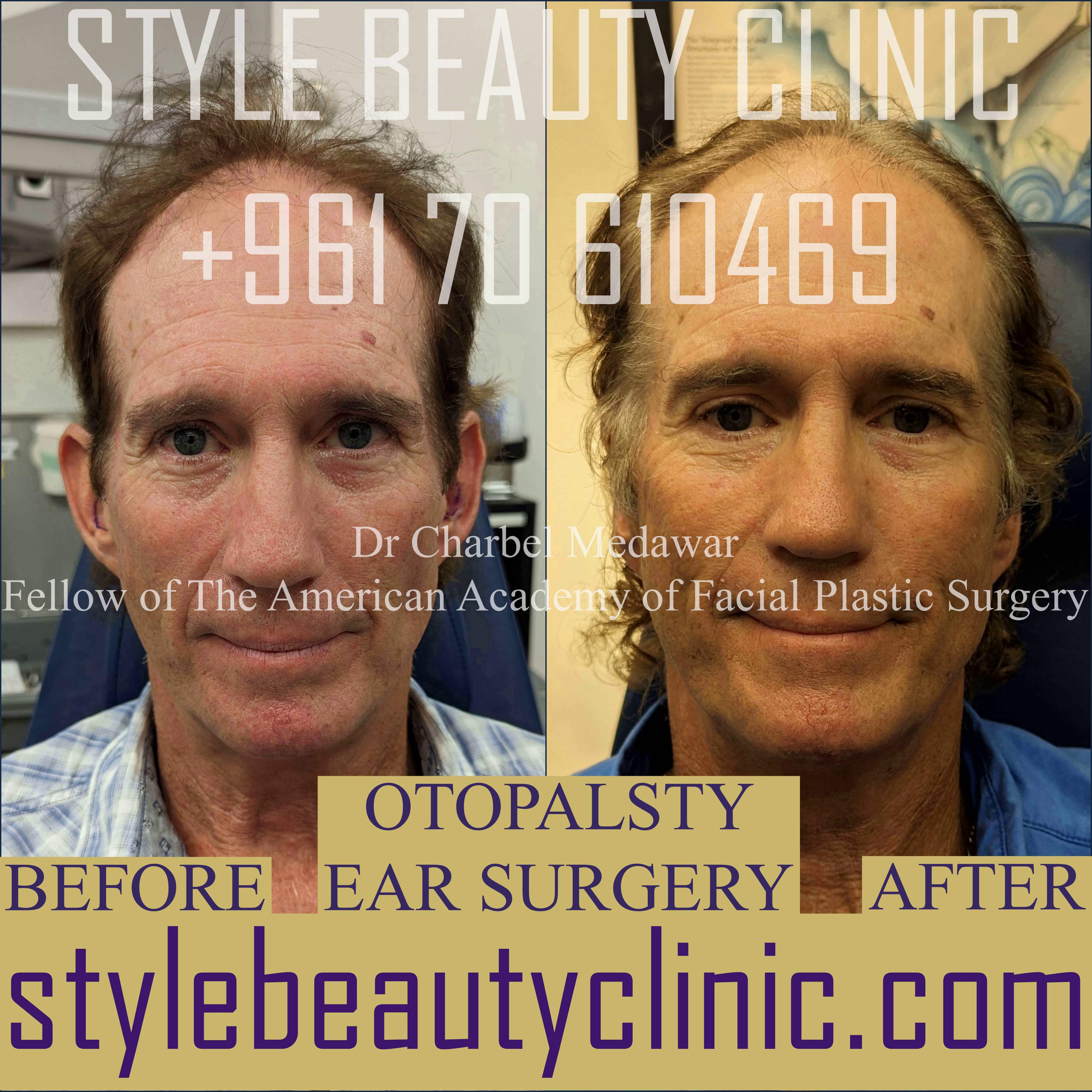 Otoplasty, Ear Plastic Surgery – Dr Charbel Medawar Plastic Surgery Lebanon