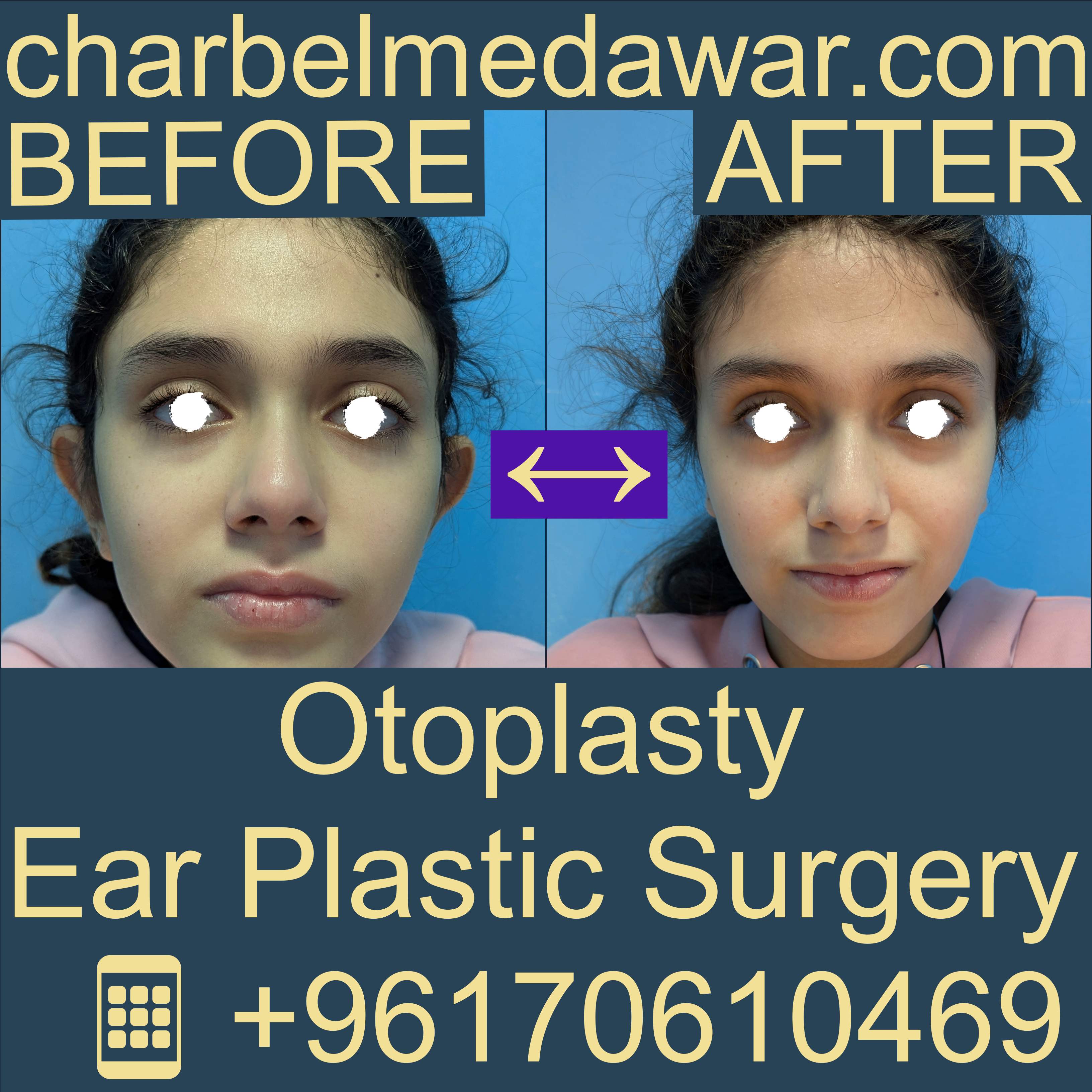 Otoplasty, Ear Plastic Surgery – Dr Charbel Medawar Plastic Surgery Lebanon
