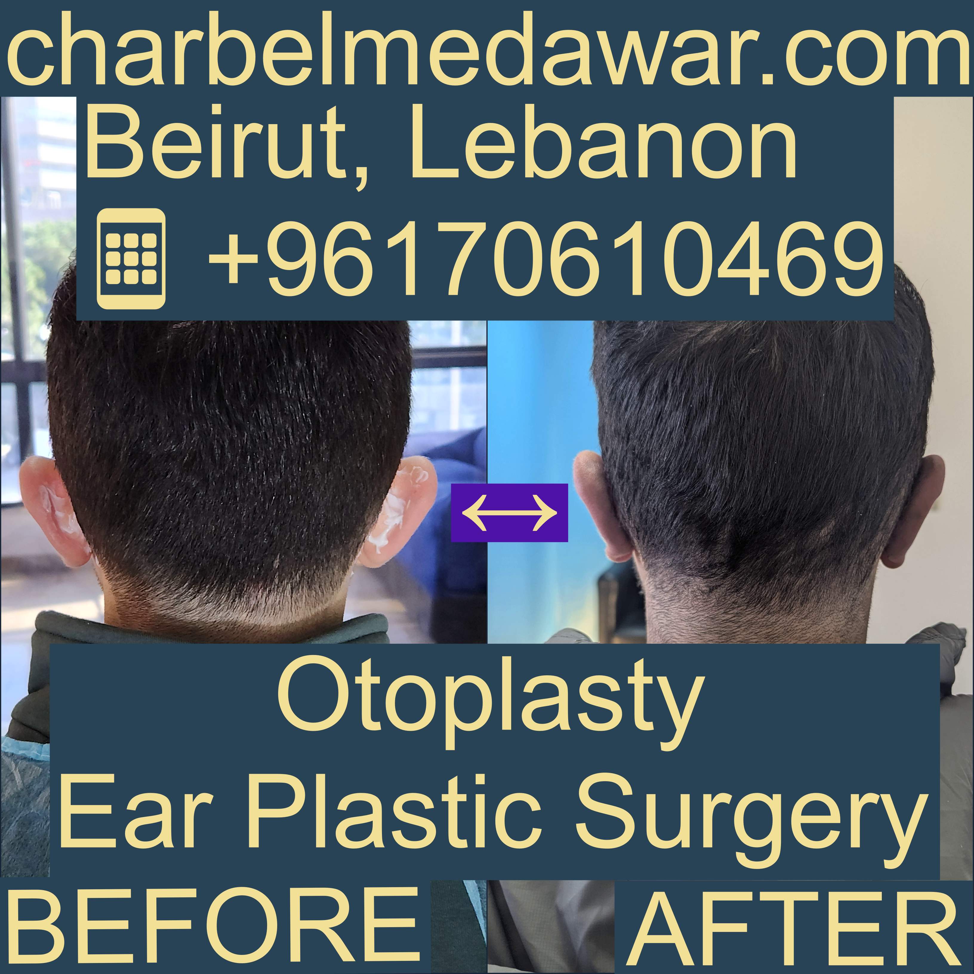 Otoplasty, Ear Plastic Surgery – Dr Charbel Medawar Plastic Surgery Lebanon